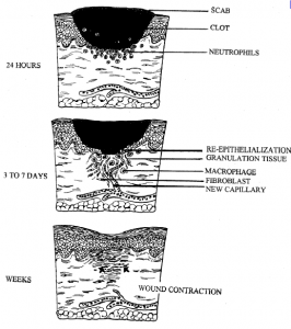Negative Pressure Wound Therapy Education | The Negative Pressure ...
